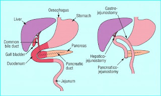 Mein Praktisches Jahr (PJ): Chirurgie - Tag 5 - "Kausch-Whipple-OP"